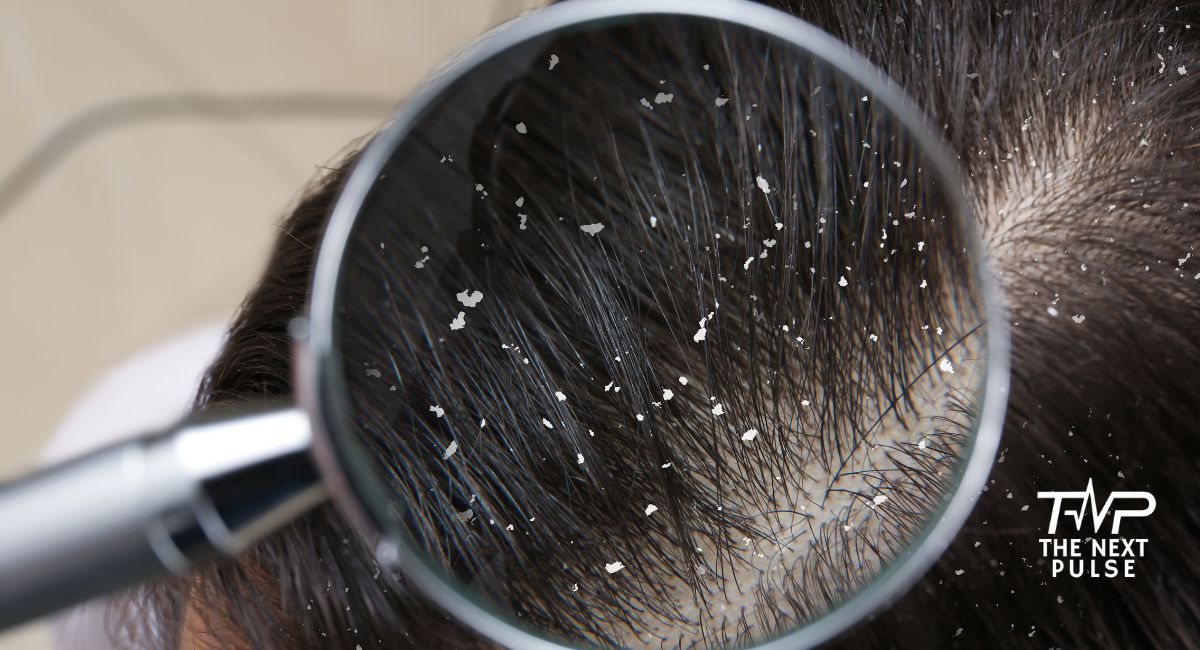 Say Goodbye to Dandruff: Proven Natural Remedies1