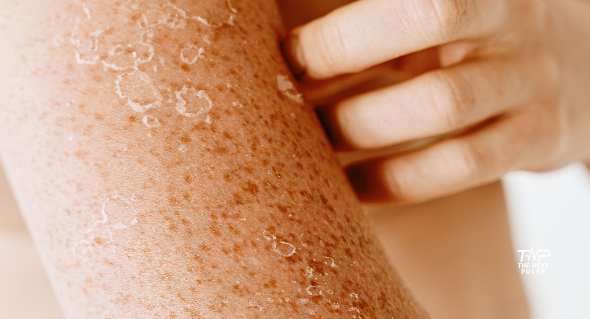 dark flaky skin treatment1