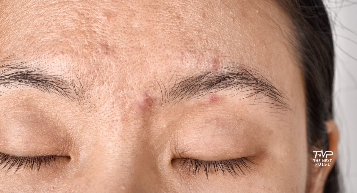 dark flaky skin treatment1